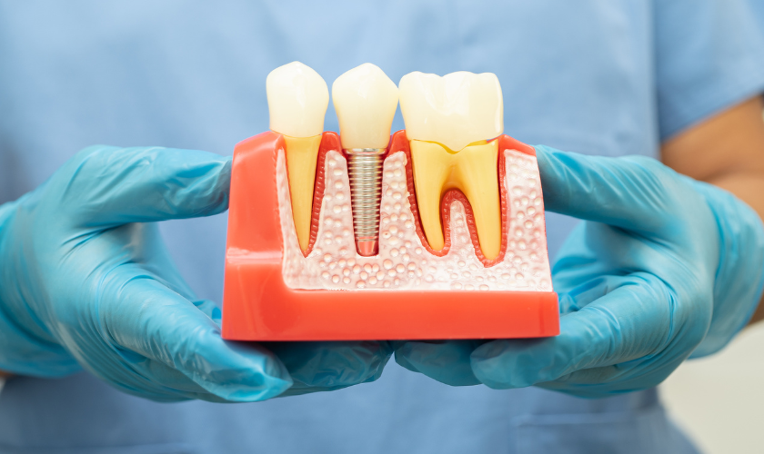 Discover Dental Implants: Your Ultimate Tooth Replacement Guide!